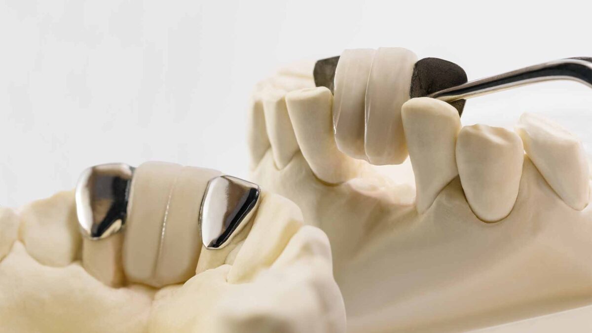 Restauração Onlay: Como é feita e quando indicar?