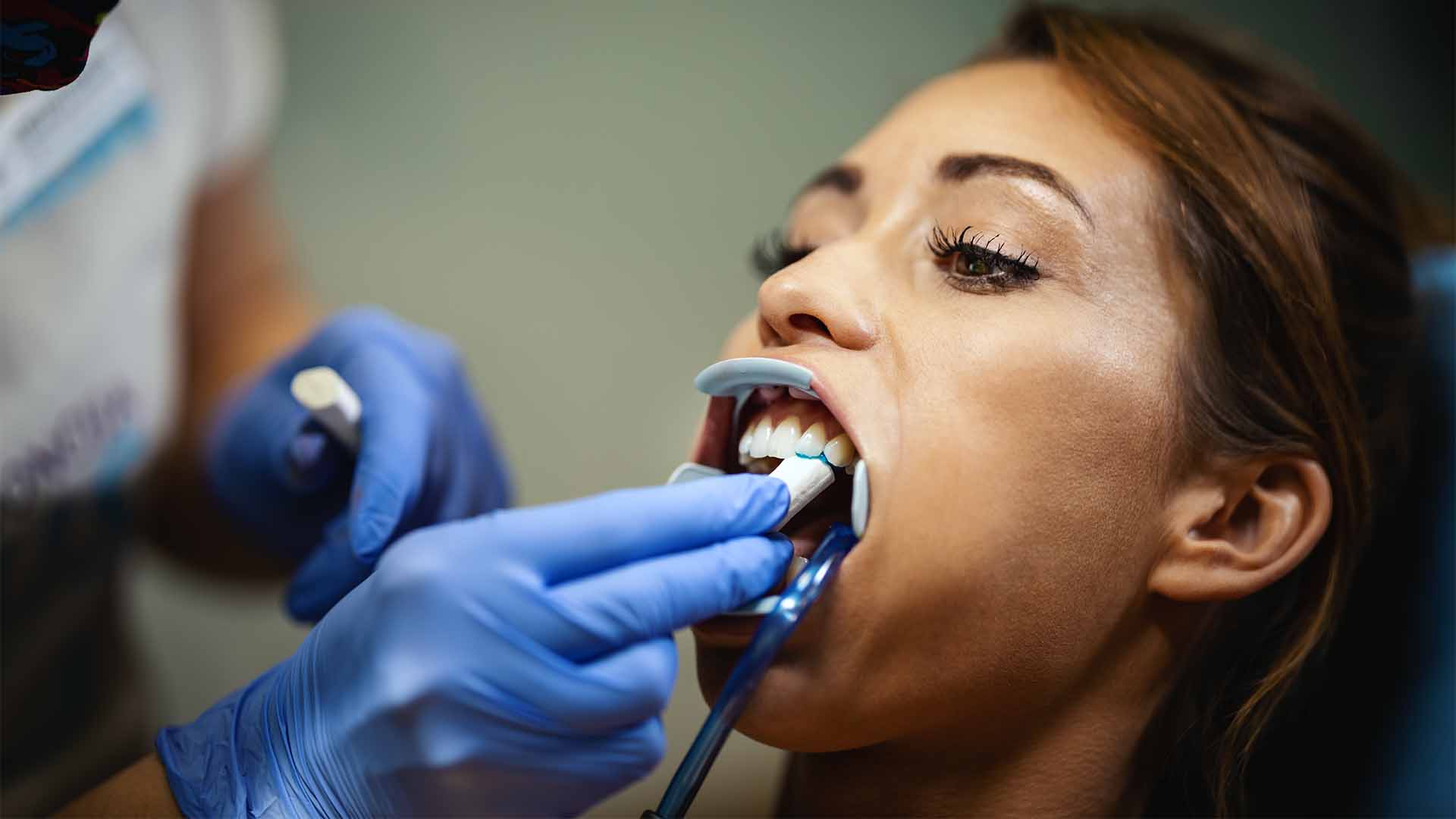 Restauração Onlay: Como é feita e quando indicar?