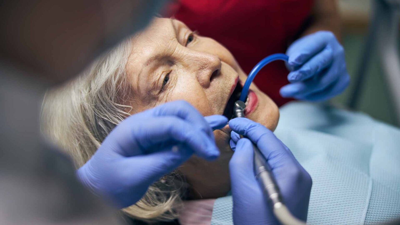 Restaurações Onlay e Inlay: Saiba as Principais Diferenças