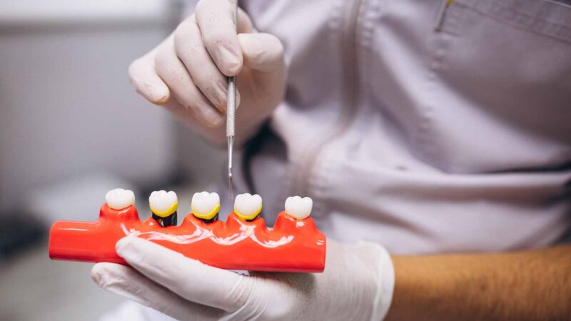 Restaurações Onlay e Inlay: Saiba as Principais Diferenças