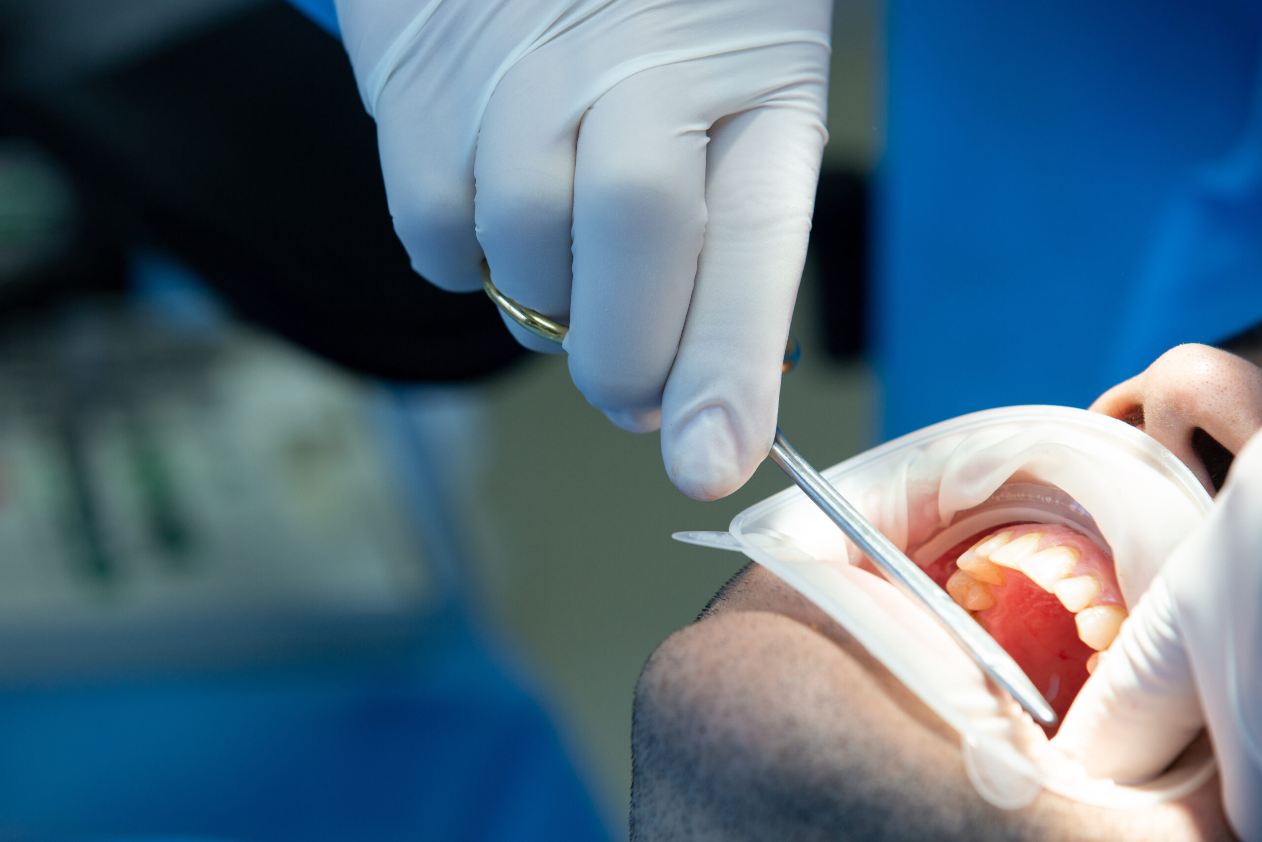 A Extração de Dentes Decíduos Pode Ser Necessária?